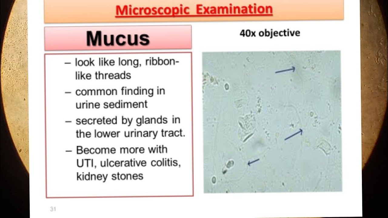 Urinalysis Mucus Rare At Ryan Strader Blog