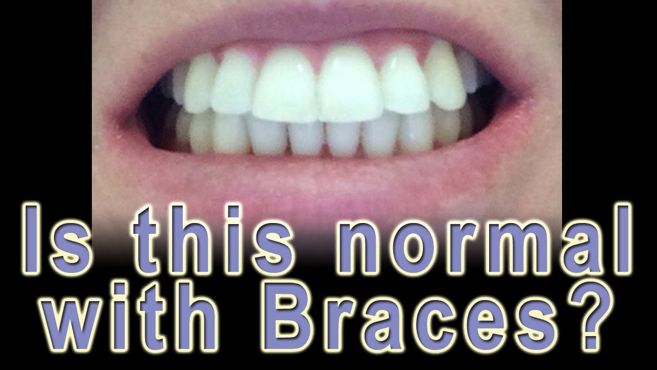 Retainer For Flared Teeth At Bridget Powers Blog