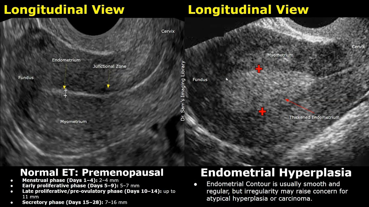 Abnormal Endometrium On Ultrasound Endometrial Disease An Overview