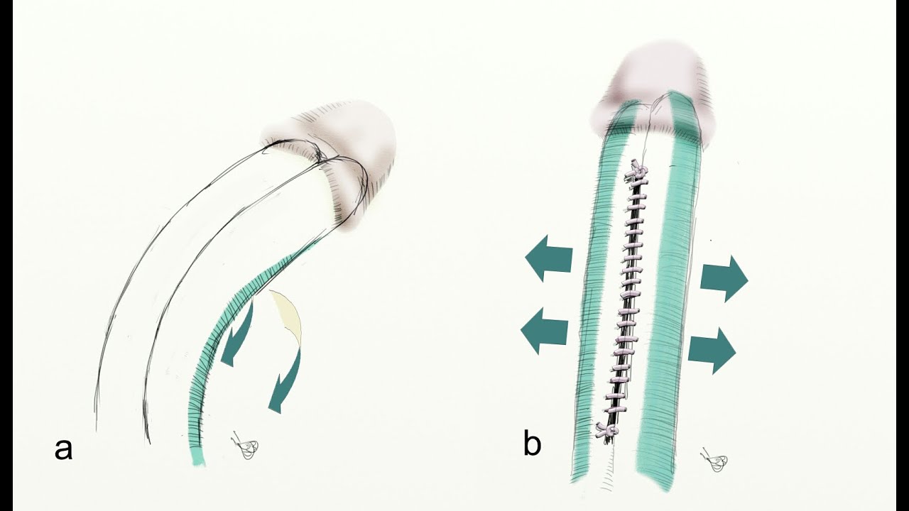 Penile Curvature Surgery Without Shortening Corporal Rotation