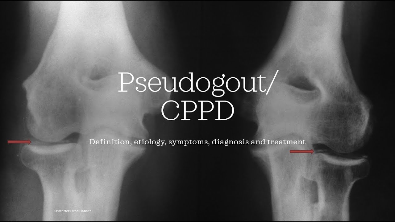 Pseudogout Xray