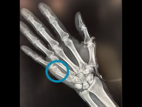 Fractura Del Boxeador Fractura Del Quinto Metacarpiano Causas Síntomas