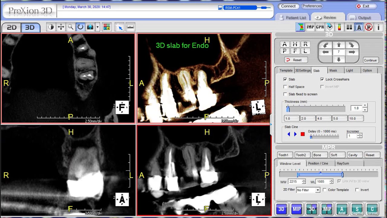 Prexion Training Tips 3d Slab For Endo Youtube