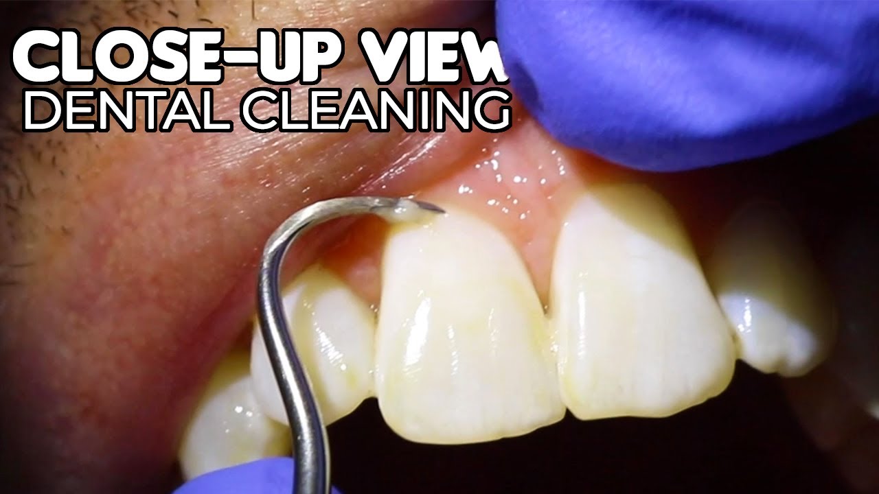 Dental Cleaning Close Up View Asmr Youtube