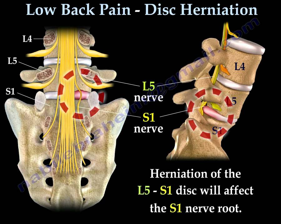 Herniated Disc L4 L5