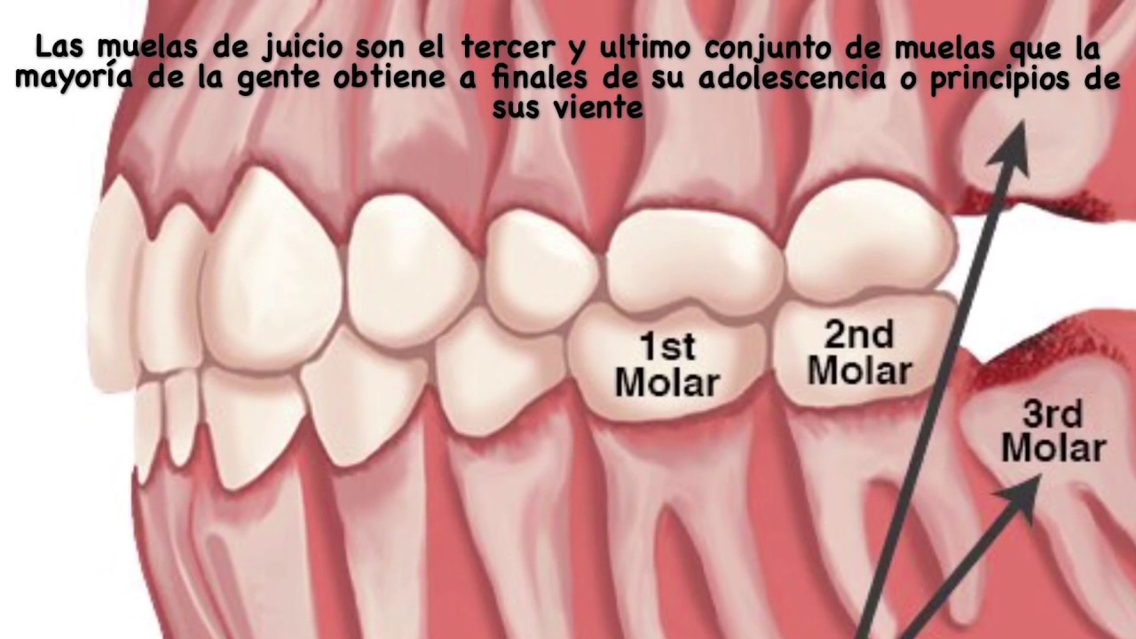 Dónde Salen Las Muelas Del Juicio Bnzpib