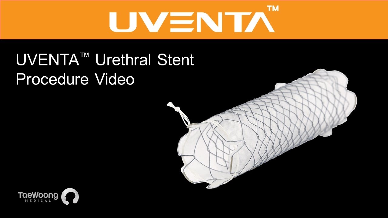 Uventa Urethral Stent Procedure Video Uventa 요도 스텐트 尿道 支架 尿道