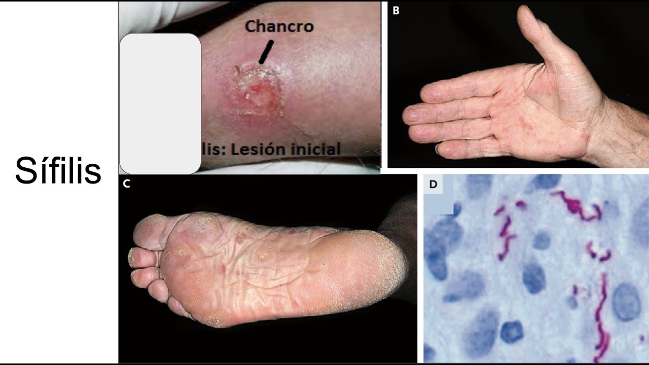 Sífilis Etapas De La Infección Diagnóstico Y Tratamiento Youtube