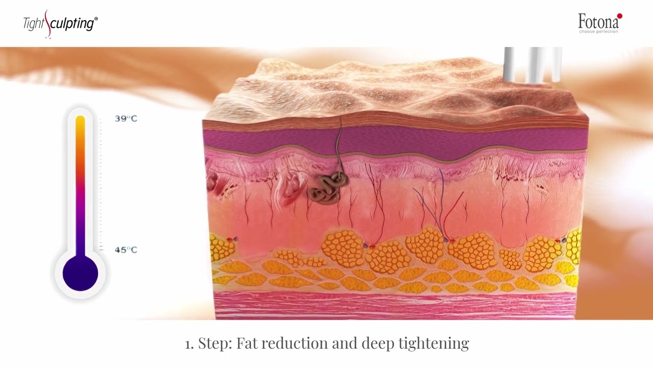 Tightsculpting Laser Treatment That Makes Your Fat Thinner And Skin