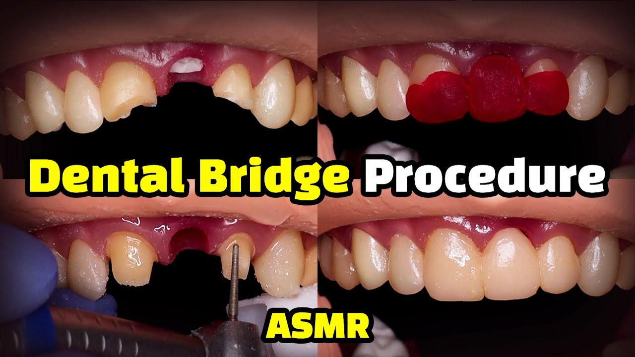 Objectives Of Dental Bridge At Kristin Knight Blog