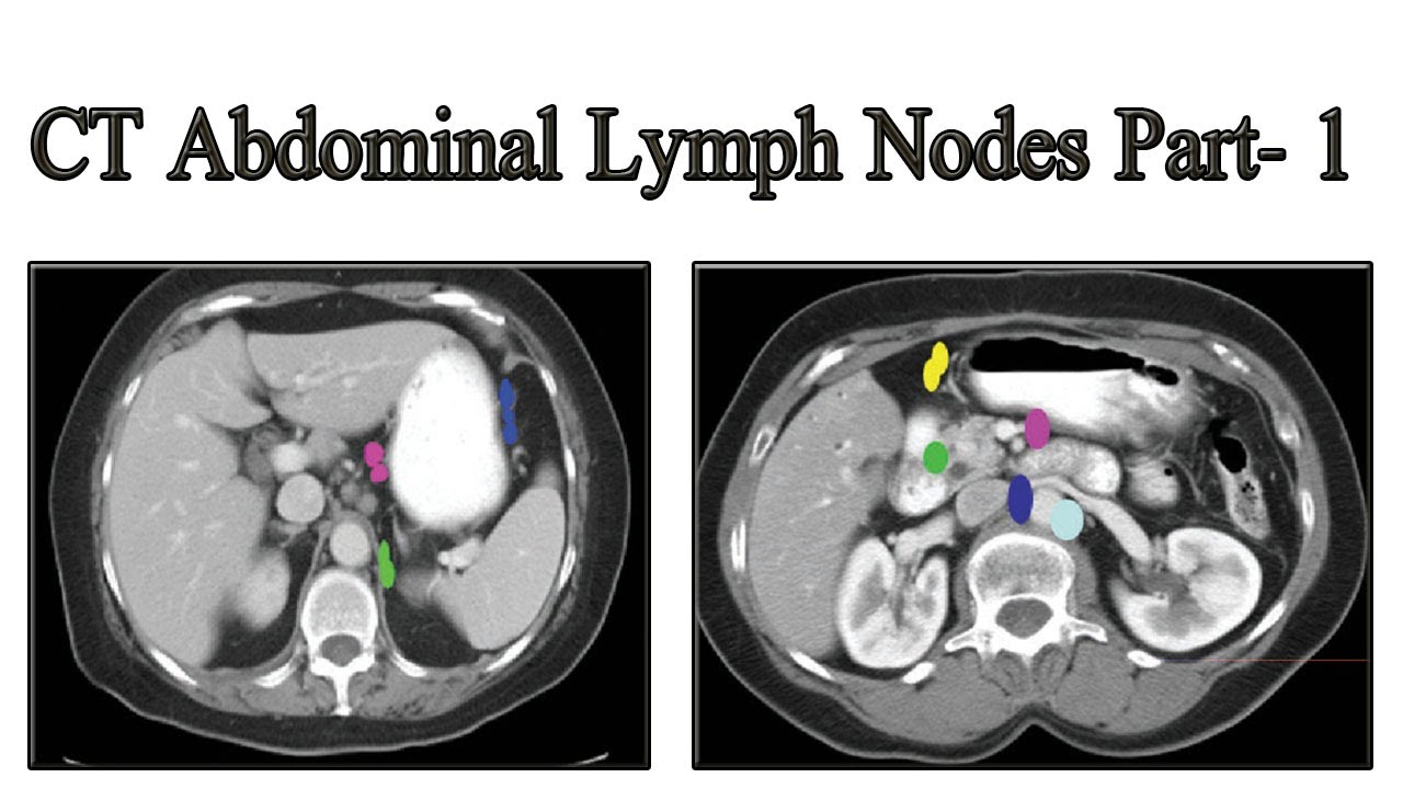 Lymph Nodes Normal Anatomy E Anatomy 57 Off