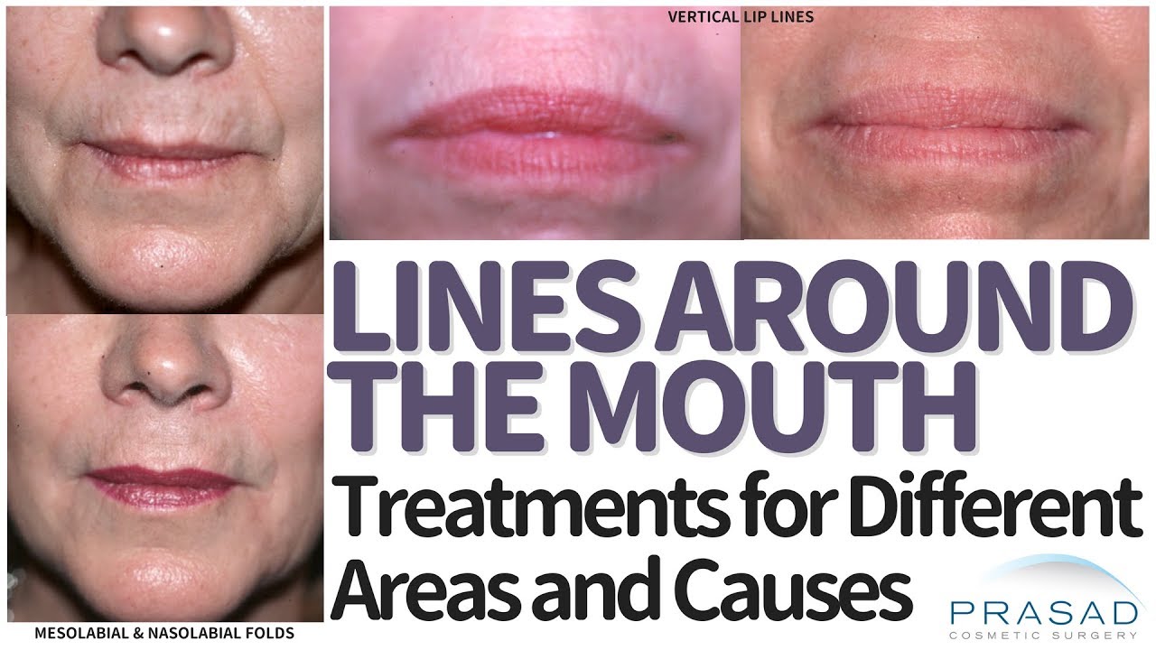 Botox Vertical Lip Lines Before After Care Infoupdate Org