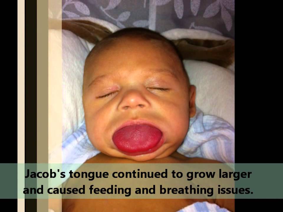 Beckwith Wiedemann Syndrome