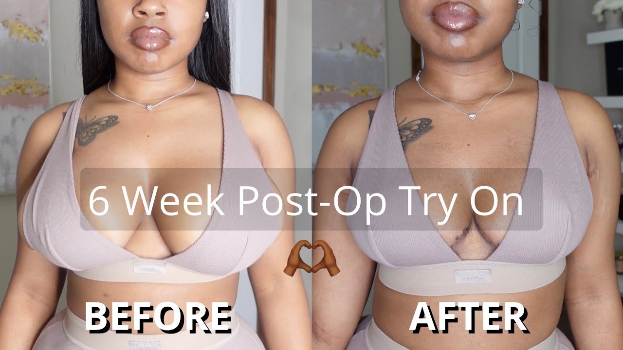 Normal Drainage After Breast Reduction At Raymond Falgoust Blog