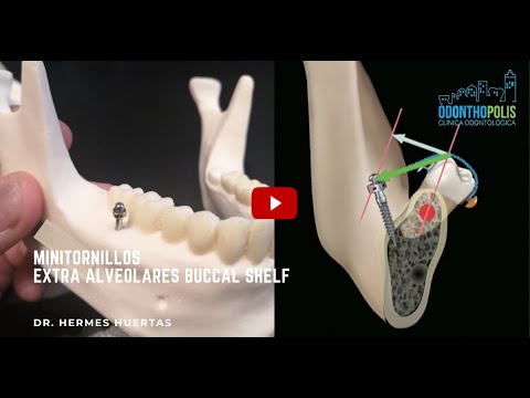 Mini Implantes En Buccal Shelf Youtube