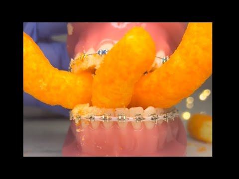 Asmr Braces Vs Doritos And Cheetos Puffs Youtube