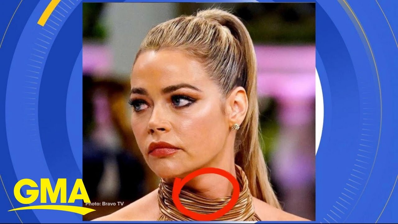 Hyperthyroidism Celebrities 60 Photos Moonagedaydream Film