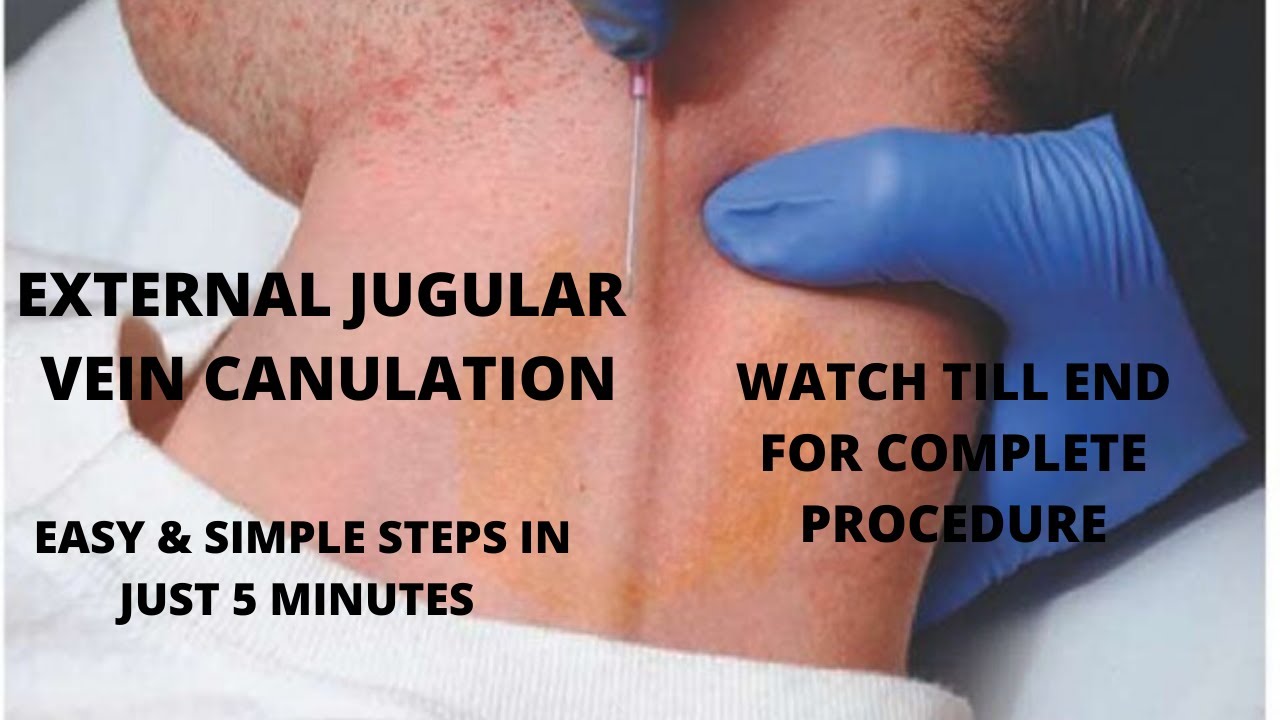External Jugular Vein Cannulation
