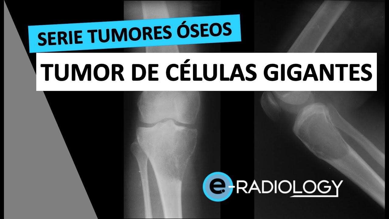 Serie Tumores óseos Tumor De Células Gigantes Youtube