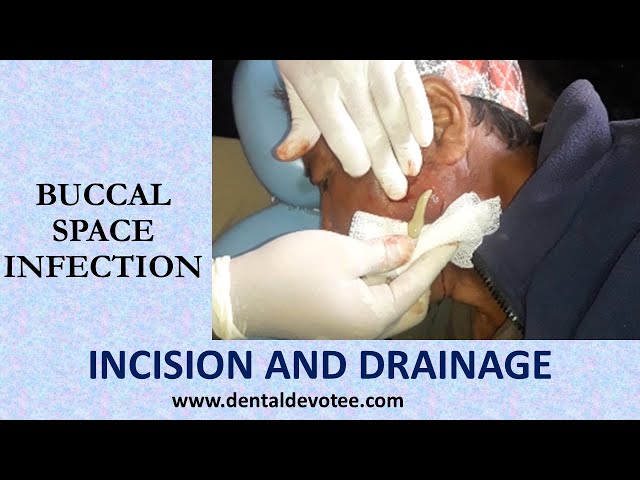 Incision And Drainage Dental Clinical Junior Quinsy