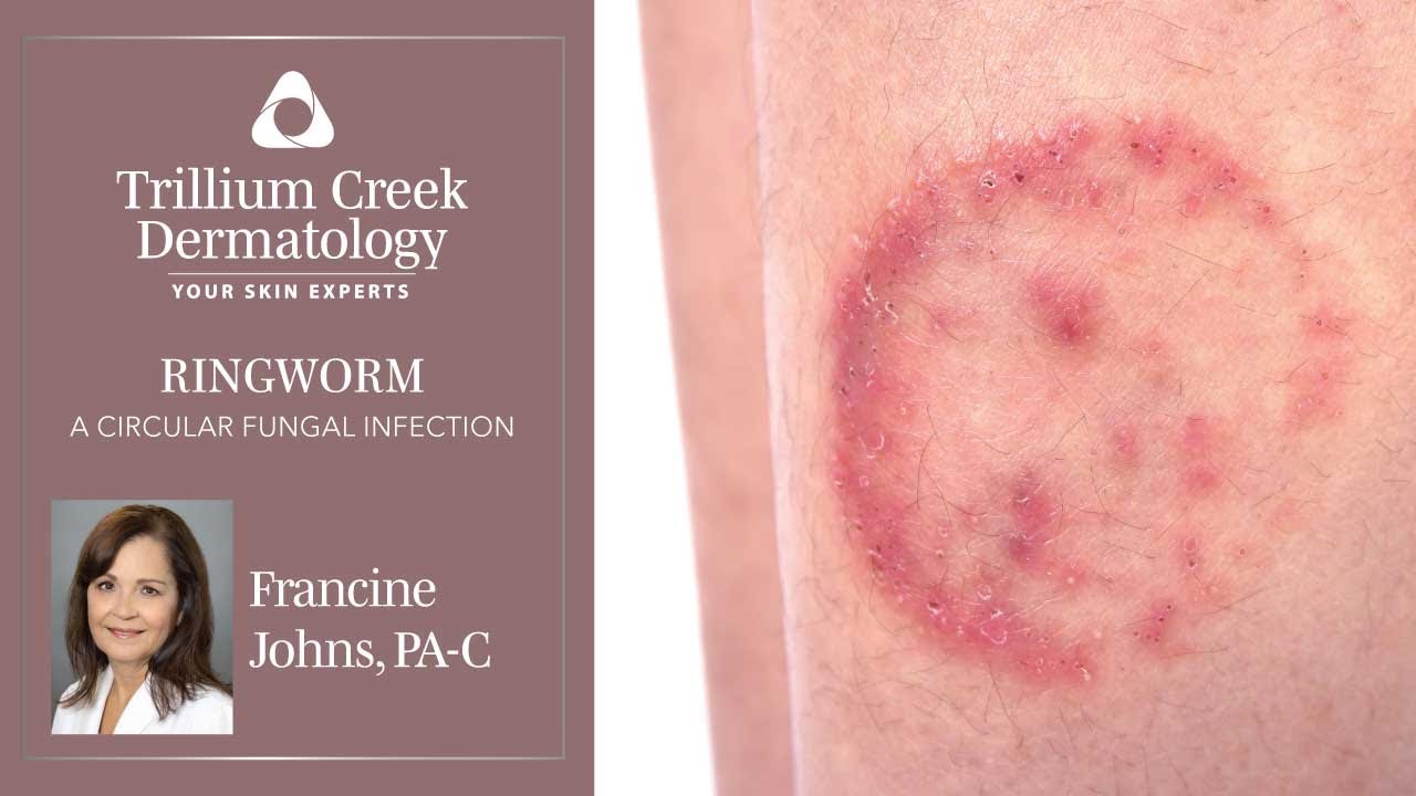 What Is Ringworm And How Is It Treated Youtube