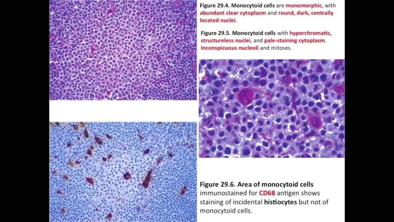 Pathological Lymph Node Subtitlejohn