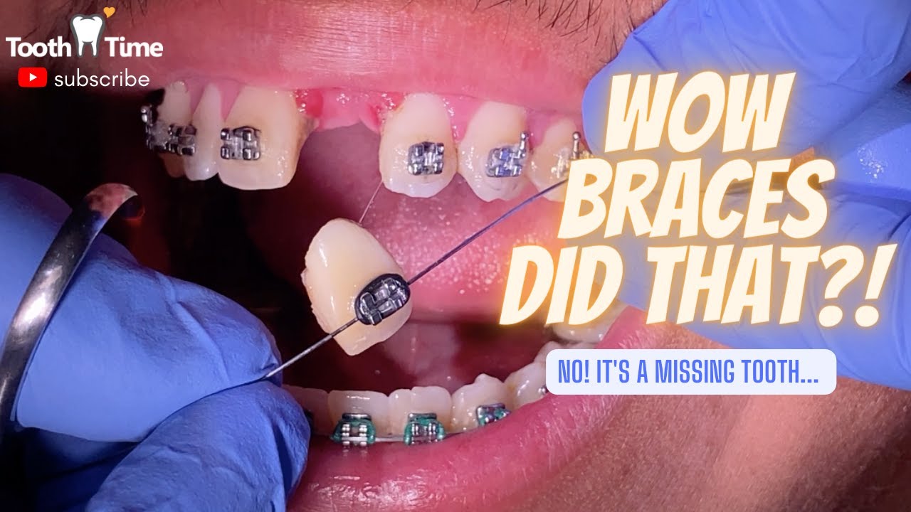 How To Wear Braces Teeth At Cynthia Chevalier Blog