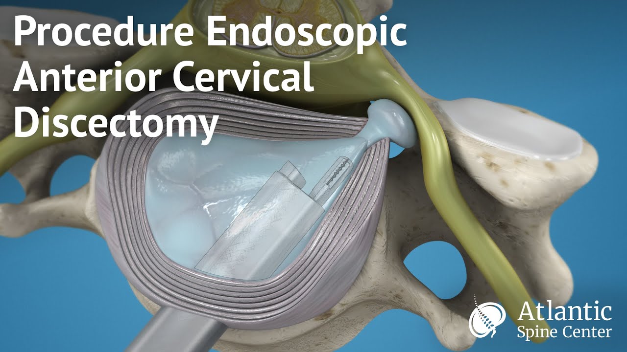 Procedure Endoscopic Anterior Cervical Discectomy Youtube