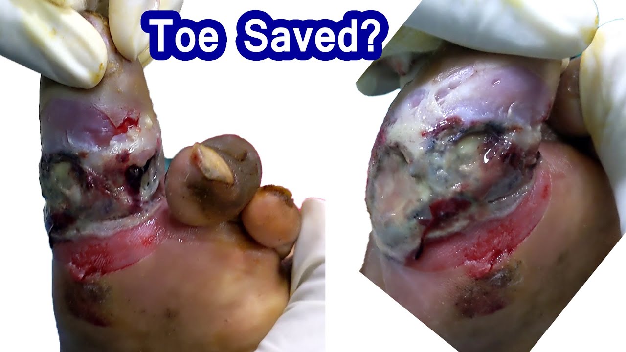 Gangrene Foot Amputation Before After Video Diabeticfoot
