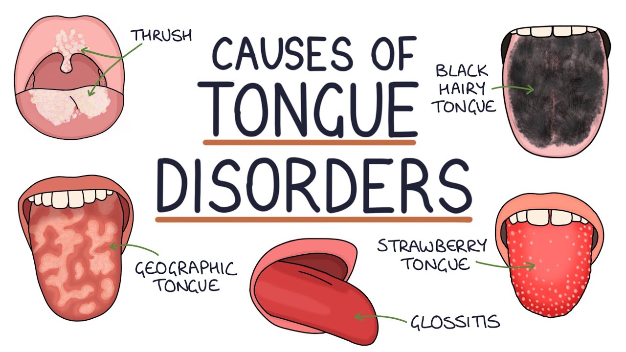 Can Stress Affect Your Tongue At Georgia Farber Blog