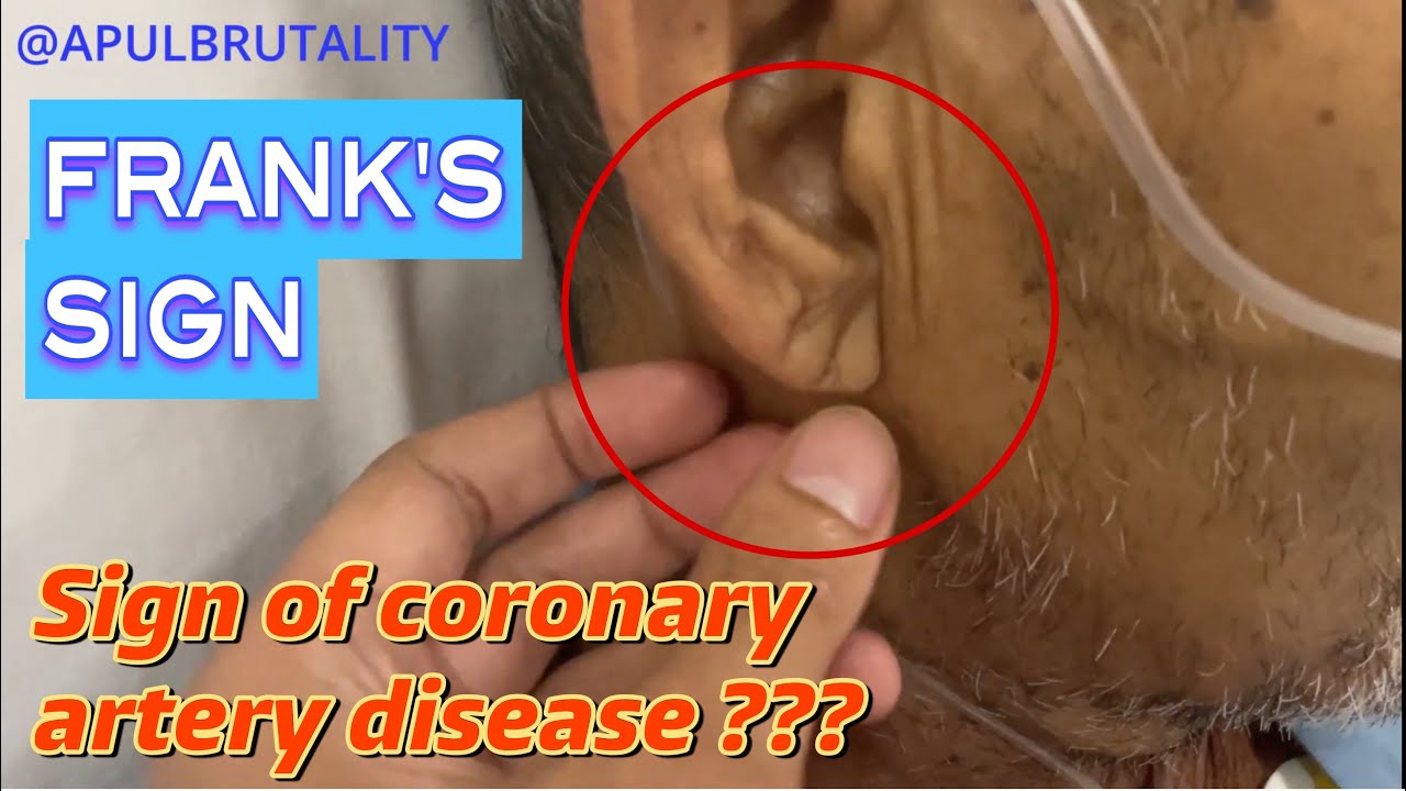 Frank S Sign Diagonal Earlobe Crease In Multivessel Coronary Artery