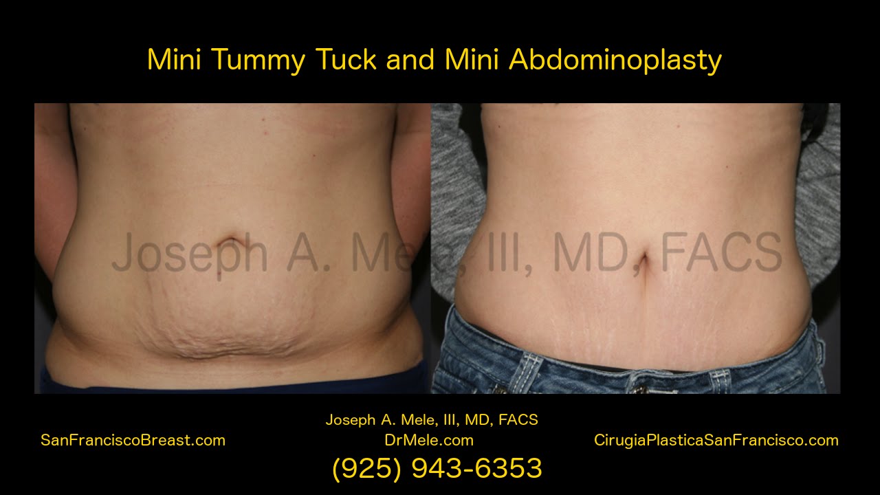 Mini Tummy Tuck Mini Abdominoplasty San Francisco Bay Area Youtube