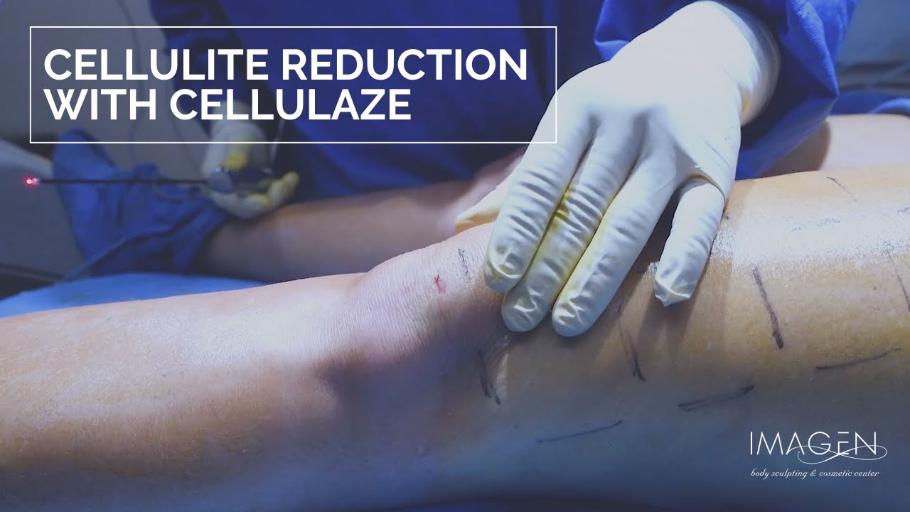 Get Rid Of Cellulite With Cellulaze At Imagen Body Sculpting Youtube