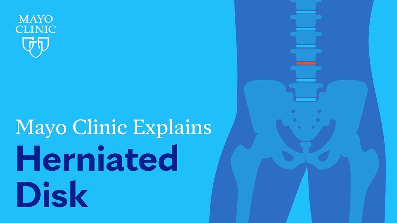 Mayo Clinic Explains Herniated Disk Medical News Alley