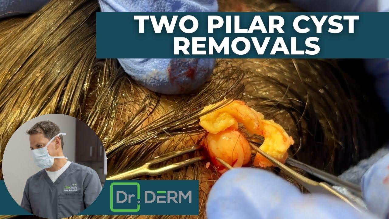 Two Pilar Cyst Removals Dr Derm Youtube