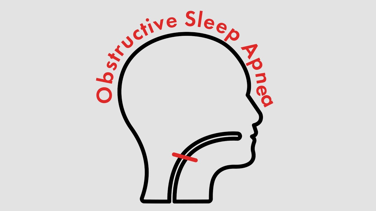 Obstructive Sleep Apnea Youtube