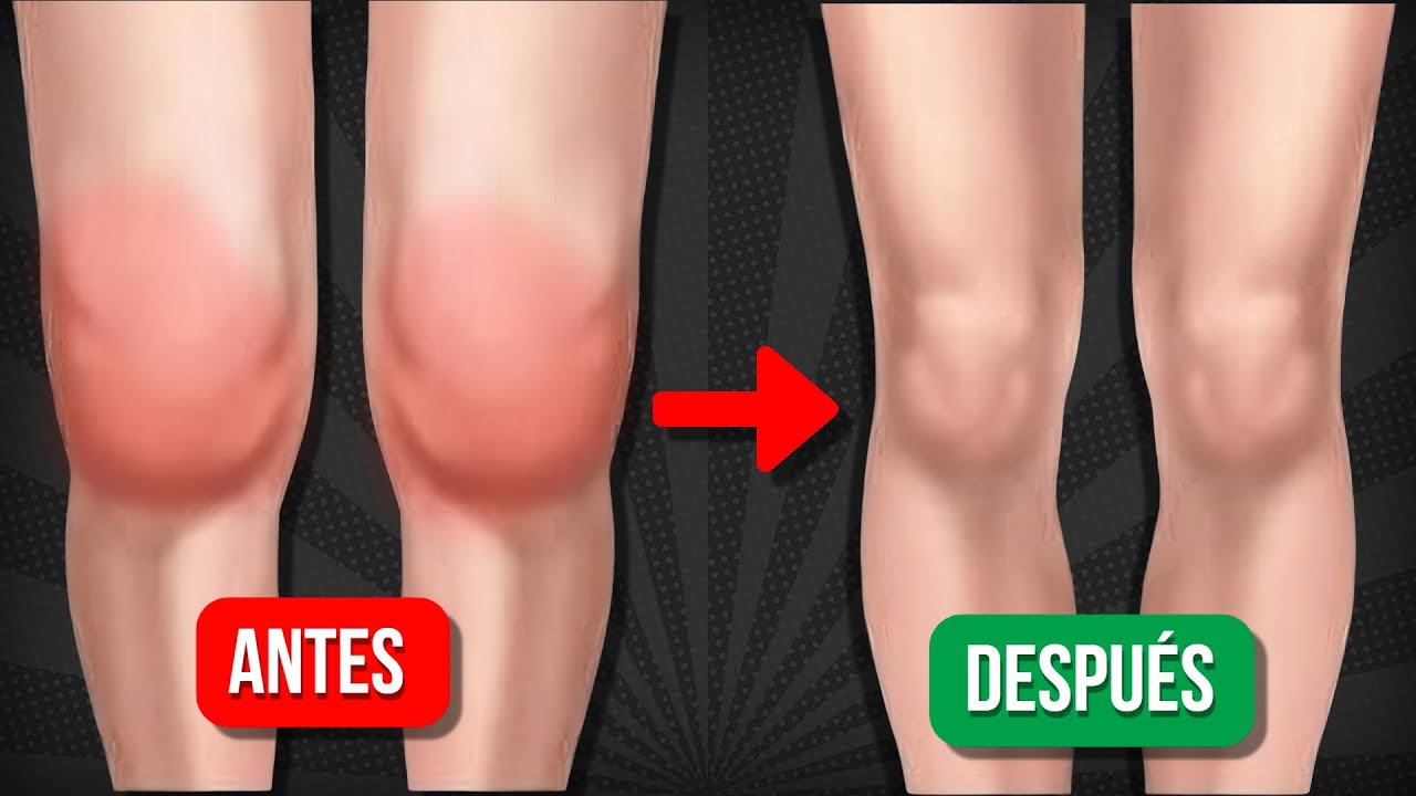 5 Ejercicios Para Desinflamar La Rodilla Y Eliminar El Líquido Youtube