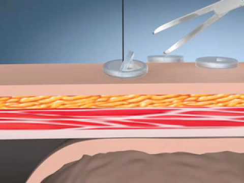 Kimberly Clark Mic G Introducer Kits Endoscopic Placement Youtube