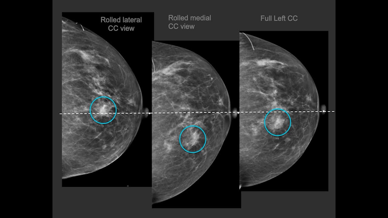 Diagnostic Mammography Youtube