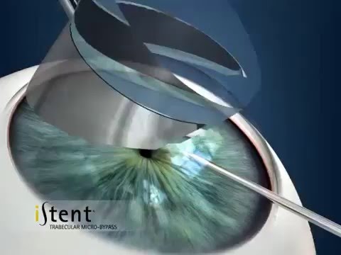Istent At West Metro Ophthalmology Youtube