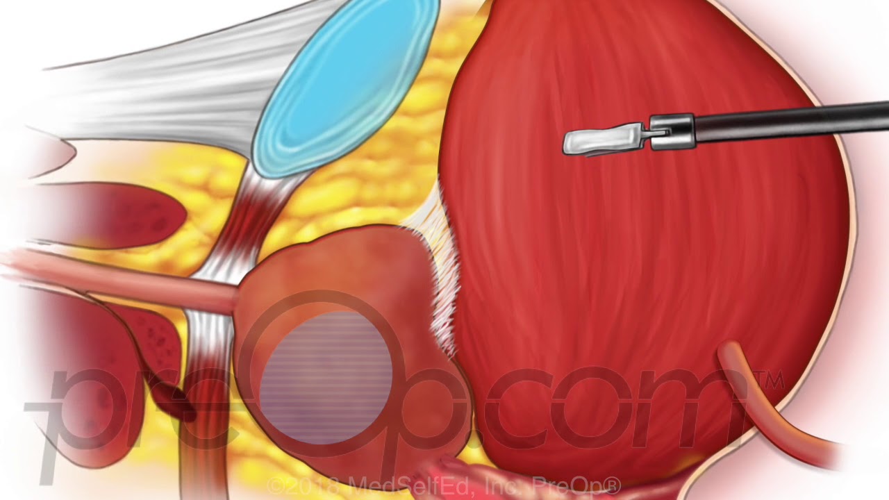 Radical Prostatectomy Surgery The Procedure Preop Patient Education