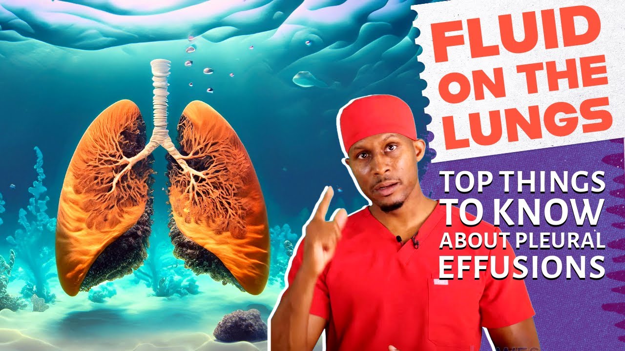 Top Things To Know About Pleural Effusions Youtube