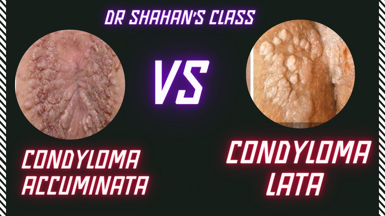 Condyloma Accuminata Vs Condyloma Lata Dermatology Fmge Neetpg