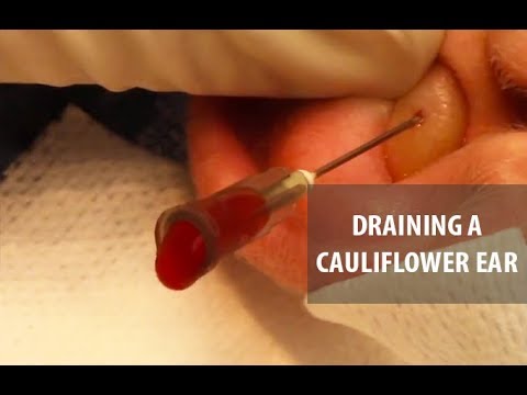 Draining A Cauliflower Ear Dr Derm Youtube