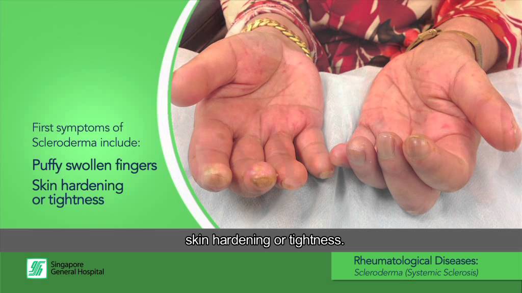 What Is Scleroderma Also Known As Systemic Sclerosis Youtube