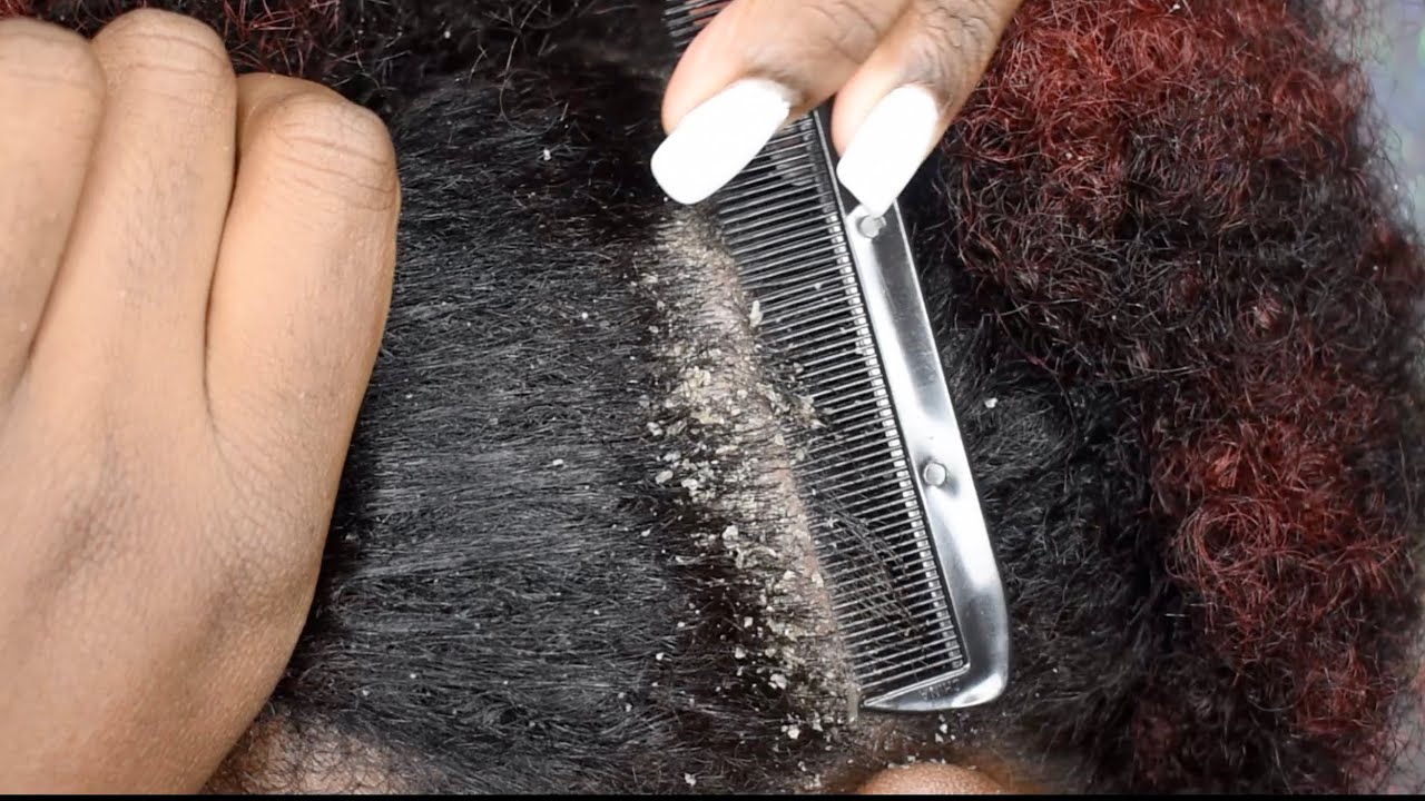 Dry Flaky Scalp Dandruff Scratching Ep13 Youtube