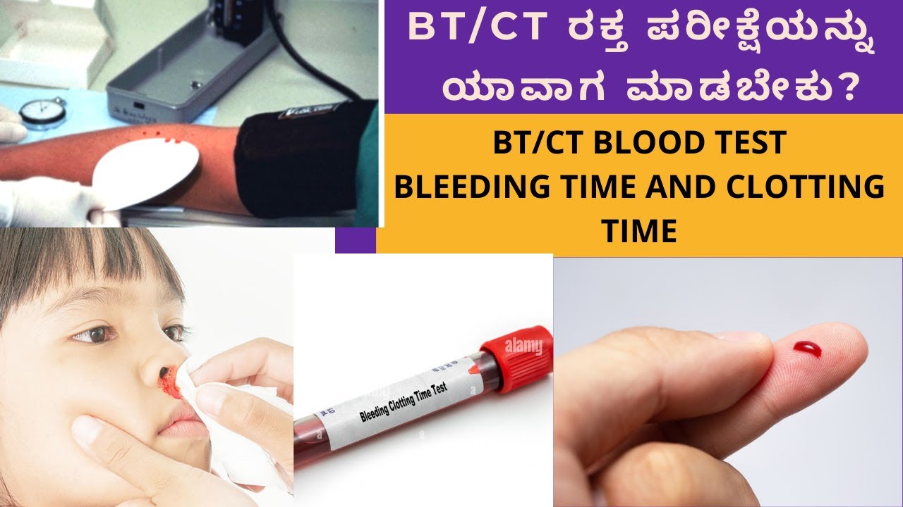 Bt Ct Test Bleeding Time And Clotting Time Coagulation 55 Off