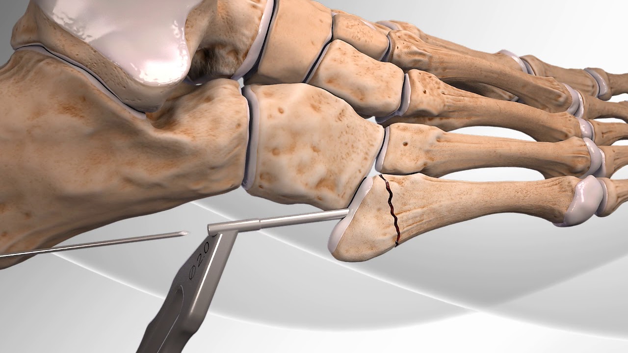 Base Of 5th Metatarsal Fracture Splint At Jasper Rae Blog