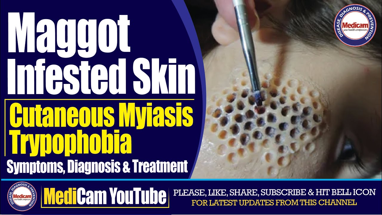 Maggot Infested Skin Cutaneous Myiasis And Trypophobia Diagnosis