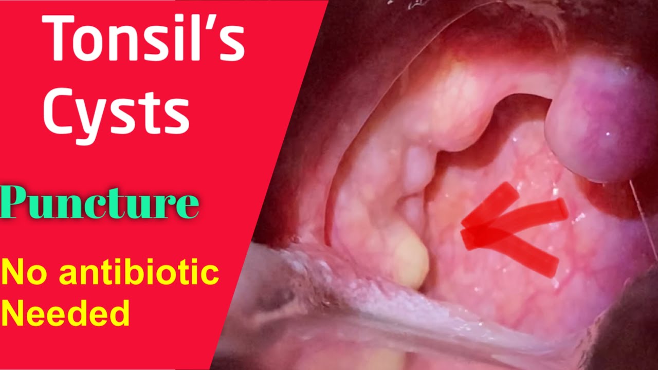 Tonsil Cyst White Thing Over Tonsil Symptoms And Management No